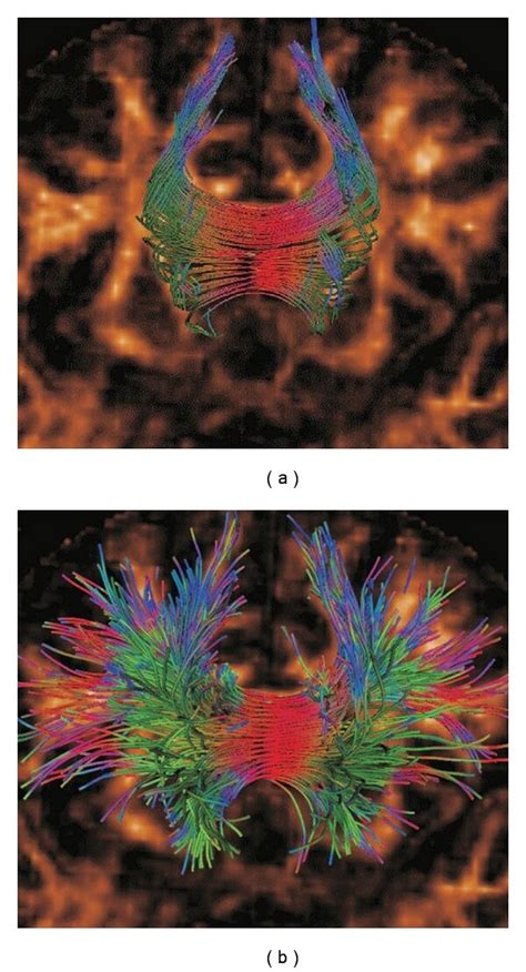 Fibers Of Part Of The Corpus Callosum Computed Using The Streamlines Download Scientific