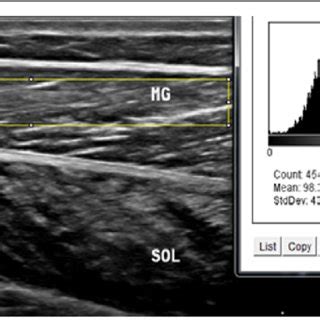 Maximum Rectangular Region Of Interest With Histogram Echo Intensity In