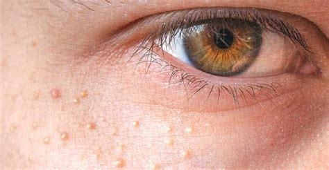 Milia What Are They And How To Treat Mens Expressions