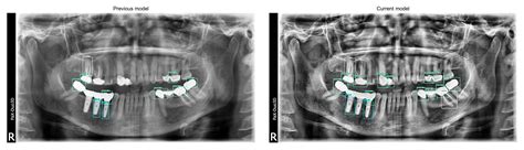 Improving Deep Learning Object Detection On Dental X Rays Clement Joudet Blog