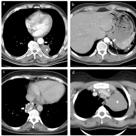 Extralobar Sequestration Asterisk Was Seen In The Left Lower Lobe Download Scientific