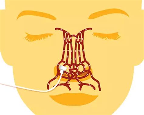 Sensor Nasal Alar Spo₂ De Philips Philips
