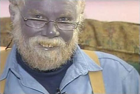 Can Real People Have Blue Skin Owlcation