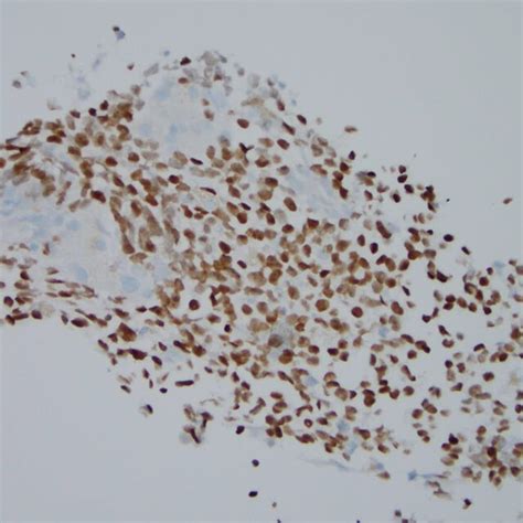 The Malignant Cells Expressed Nuclear Staining For Sox10 Confirming