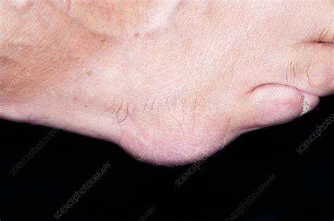 Bursitis Pinky Toe