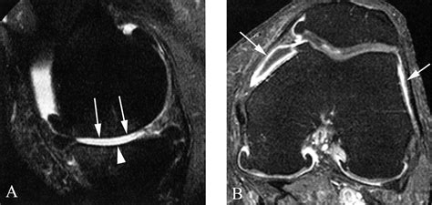 Osteoarthritis Knee Mri Imaging Of Osteoarthritis Of The Knee
