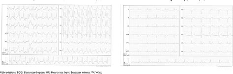 Exercise Induced Left Bundle Branch Block A Case Report With Stress Echocardiographic
