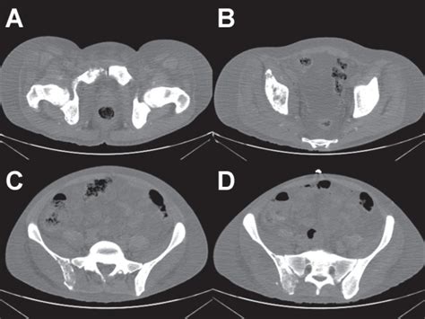 Computed Tomography Of Pelvis These Pre Treatment CT Images Download Scientific Diagram