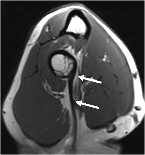 Acute And Chronic Elbow Disorders Magnetic Resonance Imaging Clinics