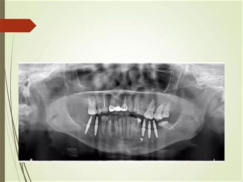 Basal Implants Types And Advantages Ppt