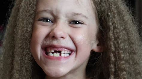 A Beautiful Five Six Year Old Girl Shows Her Mouth With Fallen Milk