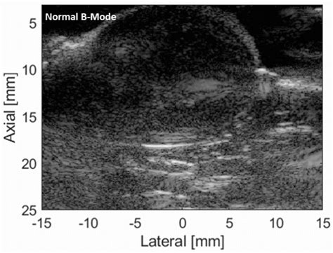 Null Subtraction Imaging Better B Mode Ultrasound Research Laboratory