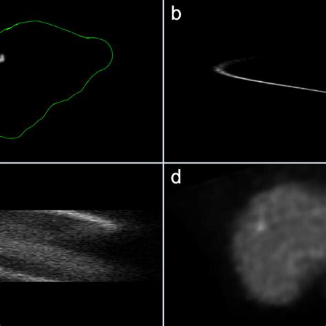 The Implementation Of A Lesion In The Liver Of A Healthy Patient A A Download Scientific