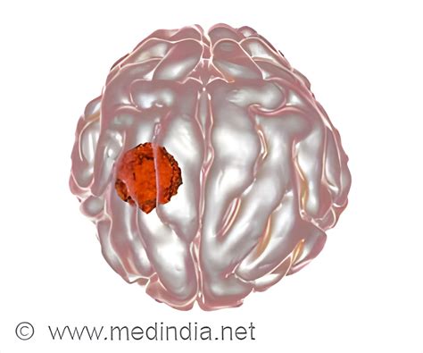 Boost Brain Tumor Outcomes With These 8 Healthy Habits