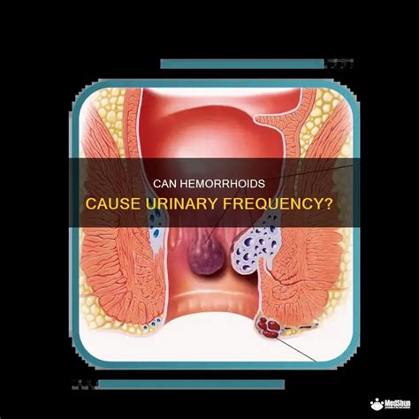 Can Hemorrhoids Cause Urinary Frequency Medshun