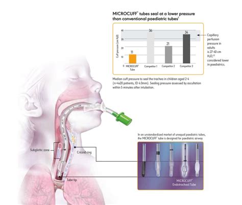 Microcuff Paediatric Endotracheal Tubes Technopath