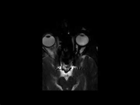 Eye Rubbing Mri 1 Youtube Mri Historical Figures Eyes