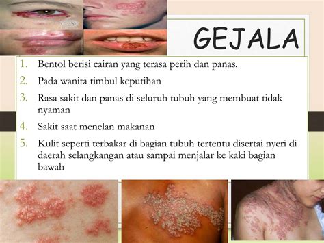 Herpes Penyakit Menular Seksual Pptx
