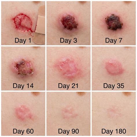 Mole Removal Healing Stages With Pictures And Timeline