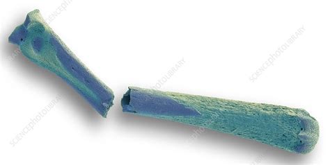 Osteoporotic Bone Sem Stock Image C033 7089 Science Photo Library