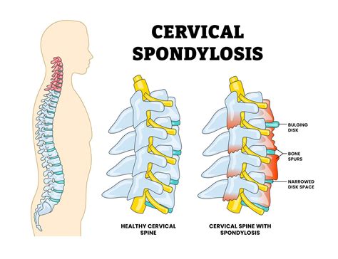 Cervical Spondylosis Spine Structure Anatomy Spinal Disease