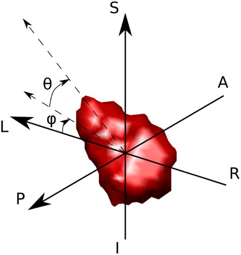 A 3d Rendering Of The Segmented Clinical Lesion Illustrated In Figure Download Scientific