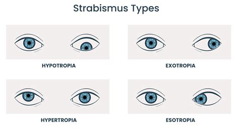 What Is Strabismus Understanding Eye Misalignment And Its Treatment