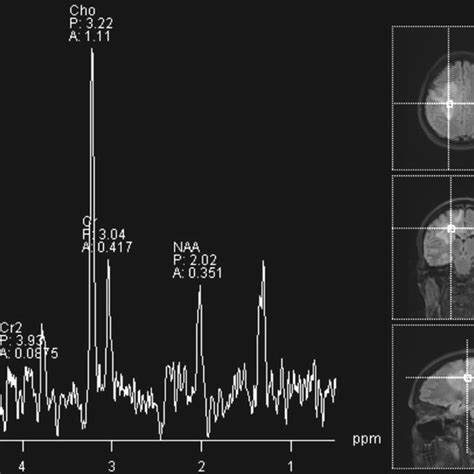 Proton Mr Spectroscopy Of A Lesion In The Right Centrum Semiovale Shows Download Scientific