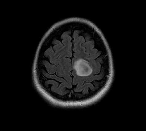 Axial FLAIR MRI Showing Glioma Two Years Later Having Grown Download Scientific Diagram