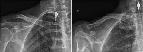 Ap And Ap Cephalic Angulation View X Rays Of The Right Shoulder Show Download Scientific