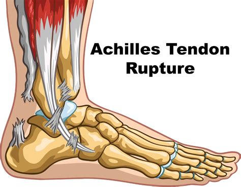 Plantar Fasciitis Vs Achilles Tendonitis Iron Garden Decor