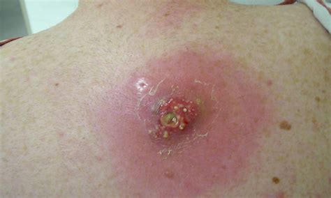 Approach To Methicillin Sensitive Staphylococcus Aureus Infections Cme Learning Center Cme