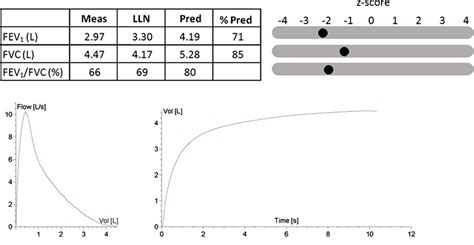 Spirometry Results For A 45 3 Year Old Caucasian Male Height Of 180 2 Download Scientific