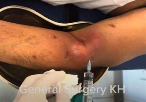 Phlebitis Abscess On Forearm New Pimple Popping Videos