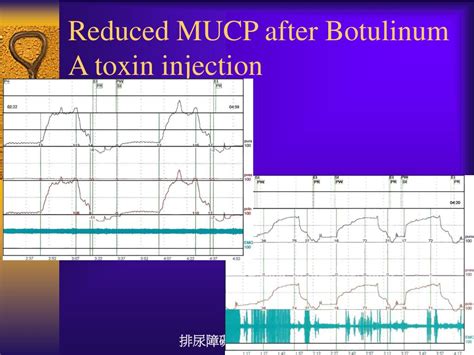 Ppt Recent Advances In Management Of The Neurogenic Voiding Dysfunction Powerpoint