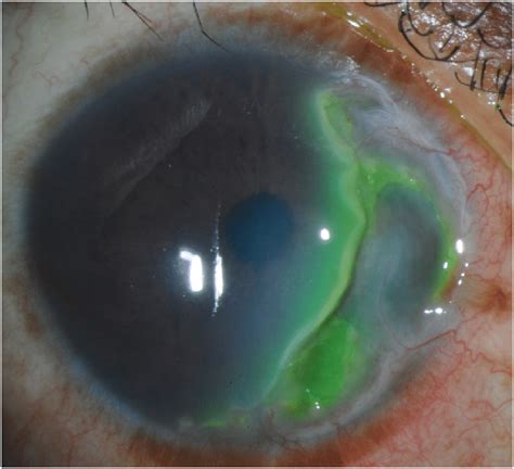 Slit Lamp Anterior Segment Photograph Using A Broad Beam Highlighting
