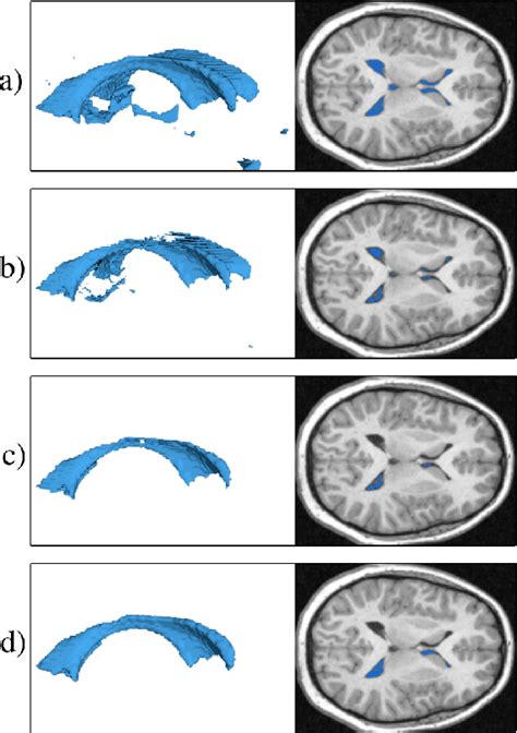 Figure 2 From A Fast Semi Automatic Brain Structure Segmentation
