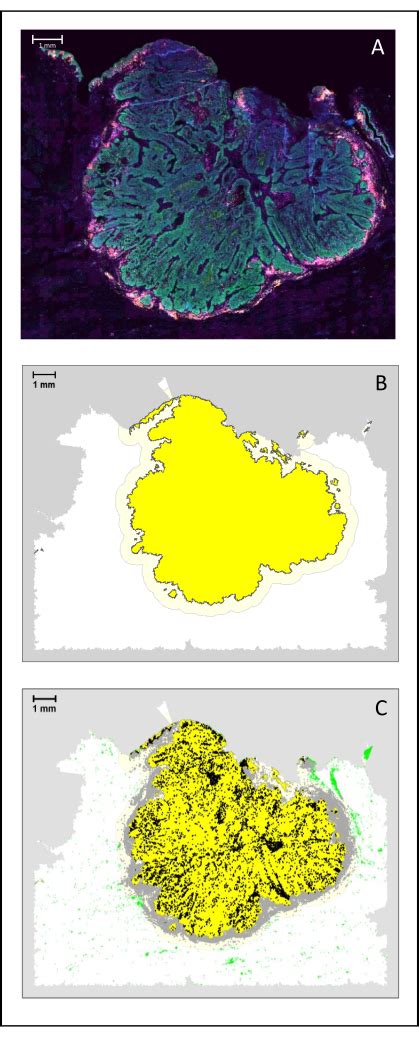 multiplex immunofluorescence combined with spatial image analysis for
