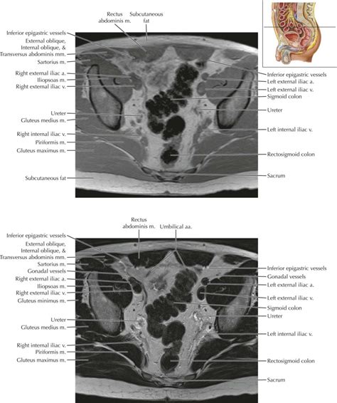 Male Pelvis Radiology Key