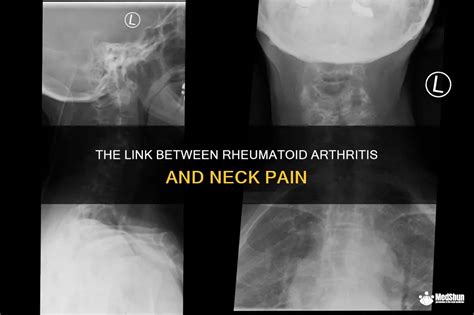 The Link Between Rheumatoid Arthritis And Neck Pain Medshun