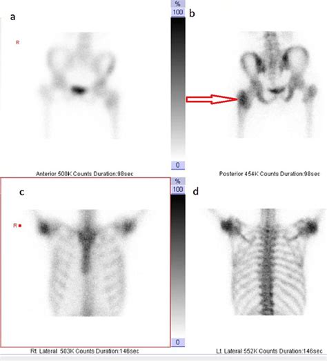 Bone Isotope Scan Showing The Amounts Of Radioactive Substances