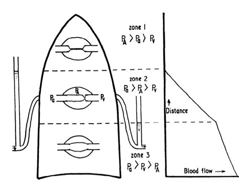 Wests Zones Of The Lung Deranged Physiology