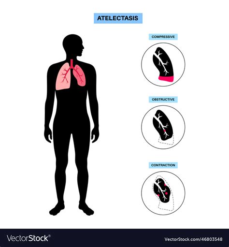 Atelectasis Medical Poster Royalty Free Vector Image