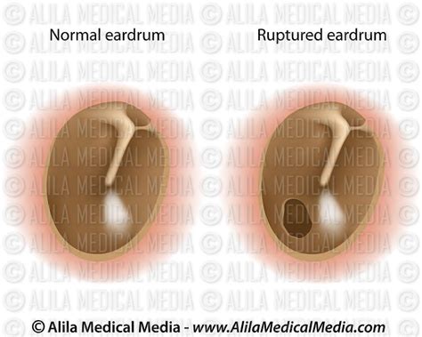 Ruptured Eardrum No Drainage At Larry Alvarez Blog