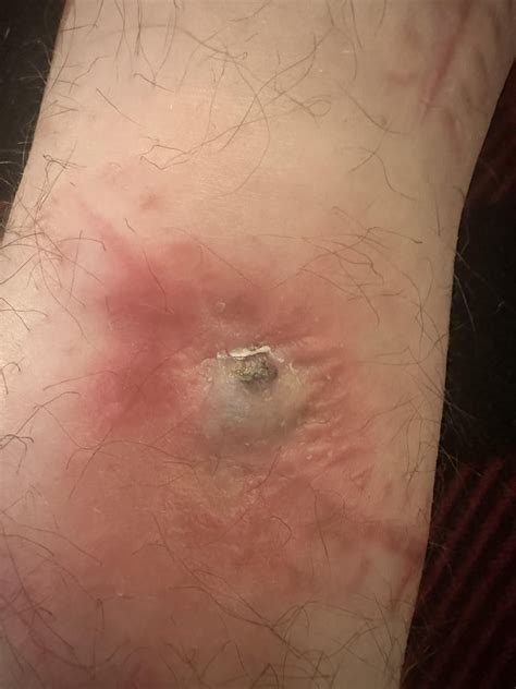 Does This Scar Look Normal Rscars