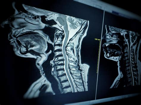 l'IRM du rachis cervical montre une compression modérée de la moelle épinière c4-c5 15763276 ...