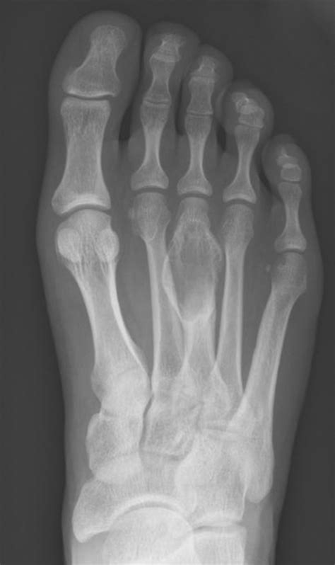 Giant Cell Tumours Of The Small Bones Of The Hands And Feet Bone And Joint