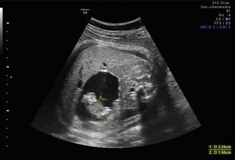 Fetus In Fetu Ultrasound