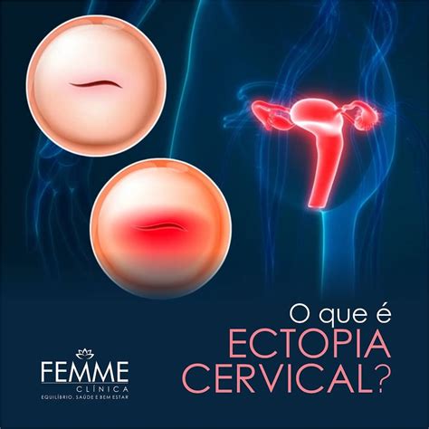 Femme Clínica Ferida No Colo Do Utero 🌸cientificamente Chamada De Ectopia Cervical 🌸É