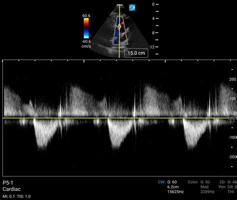 Cardiac 2 Spectral Doppler Trace Image Sonosite Institute For Point